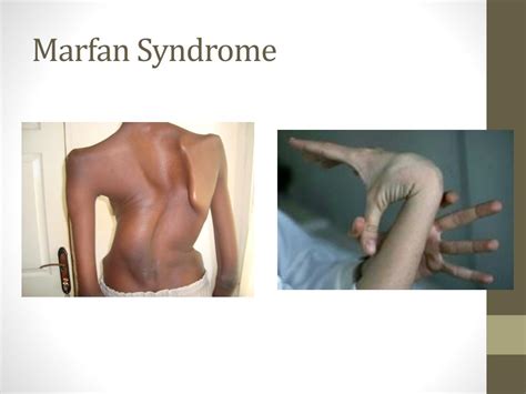 Ppt Marfan Syndrome Powerpoint Presentation Free Download Id2171771