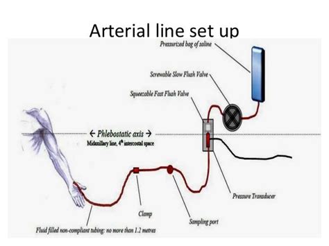 Understanding Arterial Line Setup