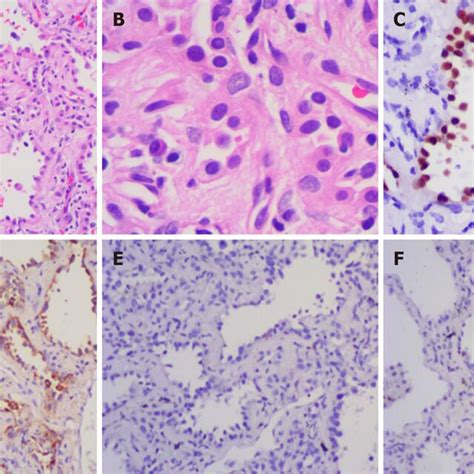 The Tissue Section Showing Lung Adenocarcinoma A 100 × Pathological