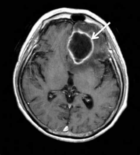 Brain Abscess Symptoms Adults