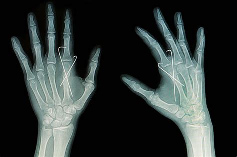 Metacarpal Fractures Assessment Management Teachmesurgery