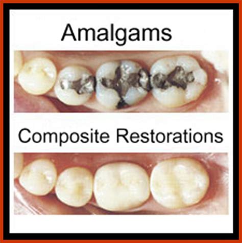 Difference Between Amalgam And Composite Restoration At Pedro David Blog