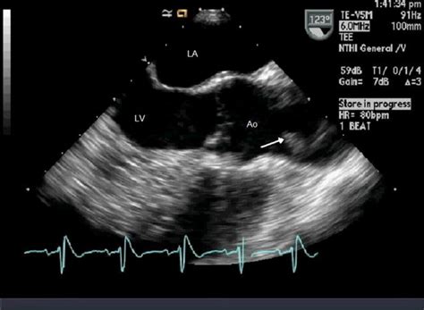 Mobile Ascending Aortic Atheroma Diagnosed By Transesophageal