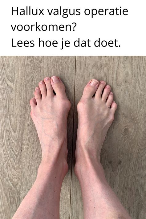 Verstuikte Enkel Oorzaak En Behandeling Met 2 Oefeningen Artofit