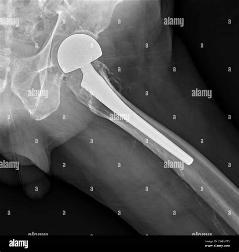 An X Ray Reveals Both Hip Joints With Total Hip Arthroplasty