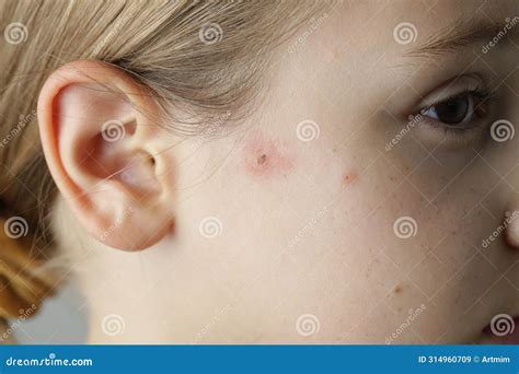 Facial Skin Closeup Allergy Dermatitis Virus Or Bacterial Infection