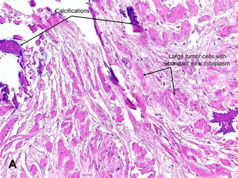 American Urological Association Large Cell Calcifying Sertoli Cell Tumor Lccsct