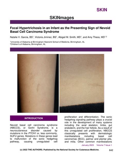 Pdf Focal Hypertrichosis In An Infant As The Presenting Sign Of