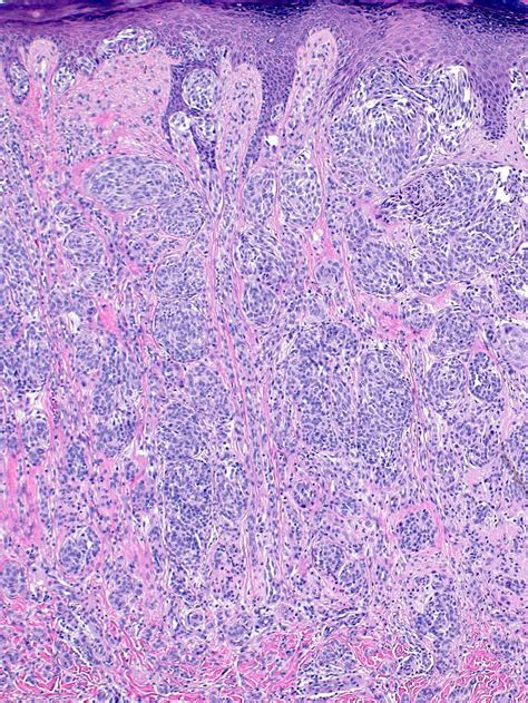 Pathology Outlines Spitz Nevus