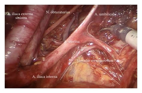 Left Vascular Mesometrium Mm With Exposed Uterine Vessels Download