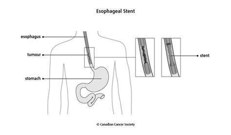 Endoscopic Treatments Canadian Cancer Society