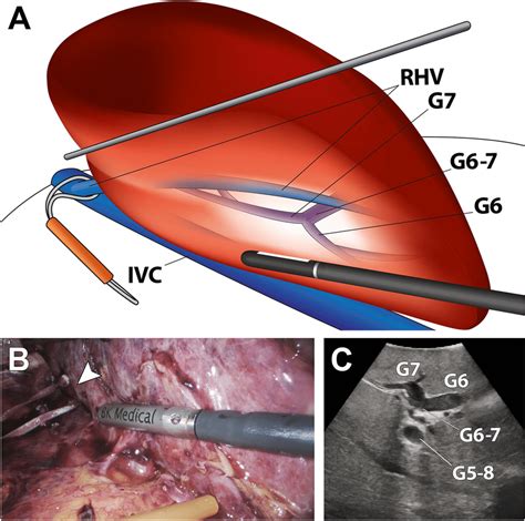Sg7 Segmentectomy Lus Exploration Schematic Representation A And Download Scientific