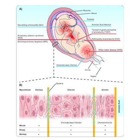 Chorioamnionitis As A Multiorgan Disease Of The Fetus A With