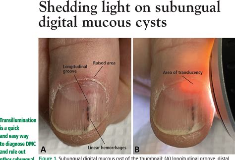 Digital Mucous Cyst