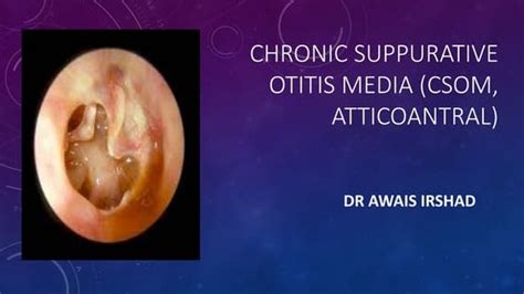Keratosis Obturans Ppt Ear Nose And Throat Conditions Diseases