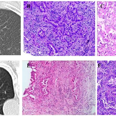 Grade Inconsistency Between Biopsy And Surgical Specimen Pathologies