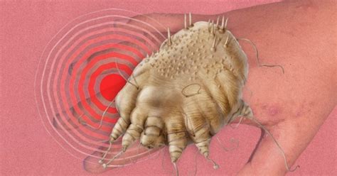 Warning Issued Over Scabies Uk Outbreak Rise Symptoms To Look Out For Uk News Metro News