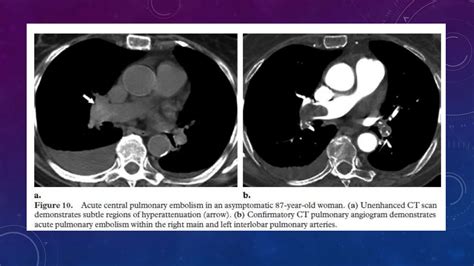 Ct Angiography Of Pulmonary Embolismpptx