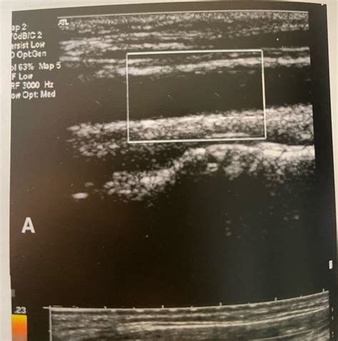 Chapter Optimizing Doppler Imaging Flashcards Quizlet
