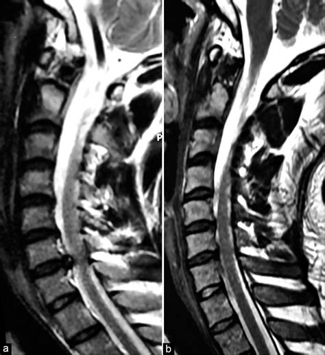 Cervical Disc Herniation Mri