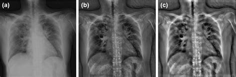Proposed Image Enhancement Procedure Outputs A A Raw X Ray Image B Download Scientific