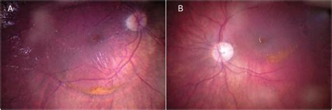 Intraoperative Color Picture Of The Posterior Pole After Core Download Scientific Diagram