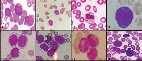 Specific Morphological Findings In Acute Leukemias Giemsa And Leishman