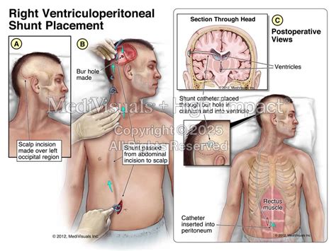 Right Ventriculoperitoneal Shunt Placement Medivisuals High Impact