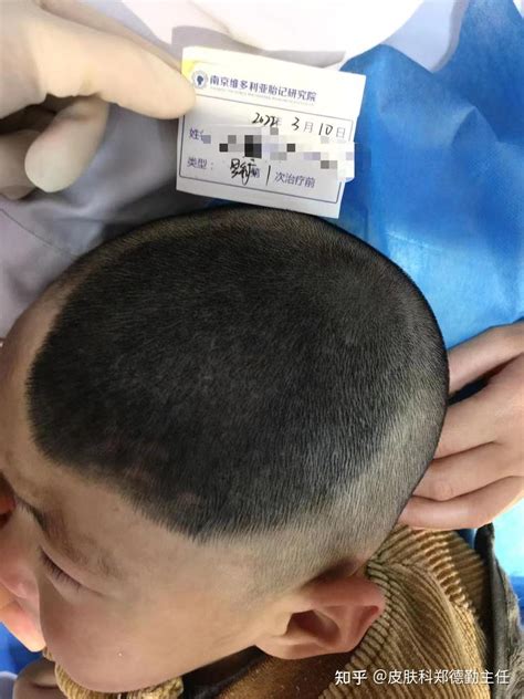 出生很小结果在头皮上不明显结果越来越大眼看就往脸上发展了 胎记跟宝宝一起长大急坏父母 知乎