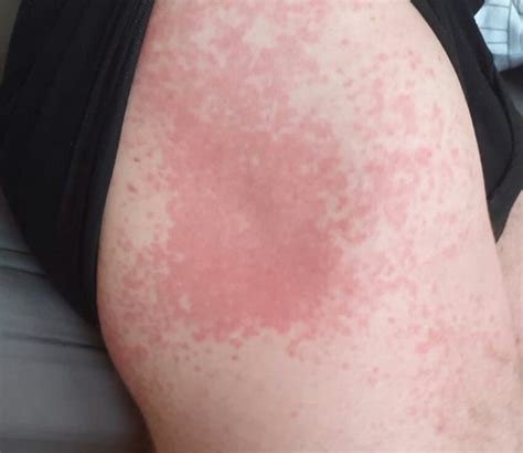 Rash On Buttocks On January 18 2023 By Guest Protected By Copyright Download Scientific