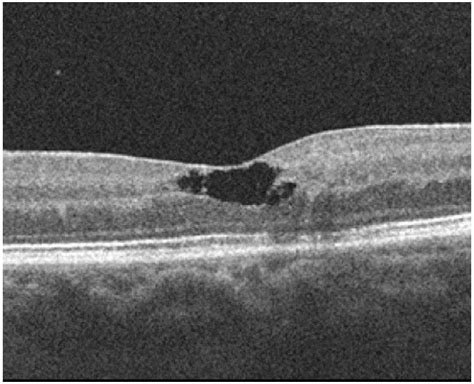 Outer Retinal Cavity Formation From Photoreceptor Disruption Some