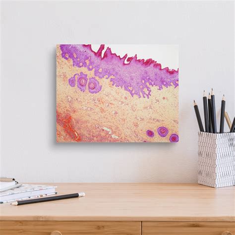 Necrotizing Fasciitis Light Micrograph Canvas Print Canvasworld