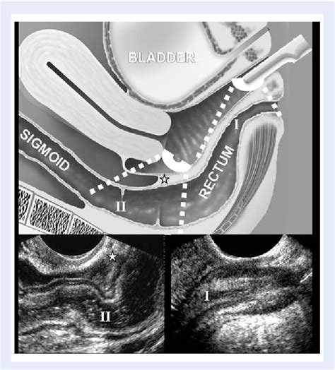 Figure 1 From Transvaginal Ultrasonography With Bowel Preparation Is