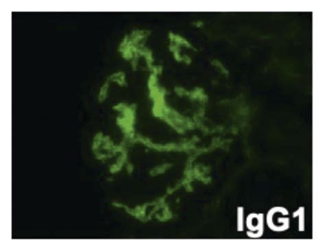 Renal Biopsy Showing Deposition Of Immunoglobulin G Igg And