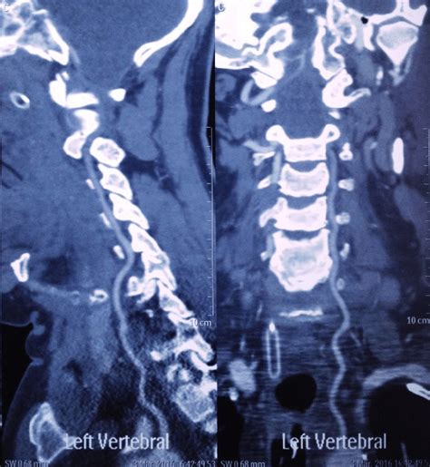 Absent Flow In V3 V4 Segment Of Left Vertebral Artery Download Scientific Diagram