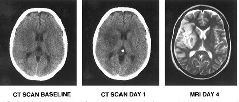 Figure 1 From Thrombolysis With Intravenous Rtpa In A Series Of 100