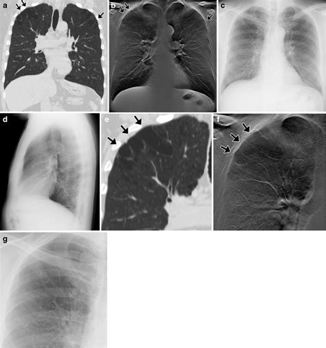 A 59 Year Old Man With Pulmonary Emphysema Who Had An Laa −950 Value Of Download Scientific