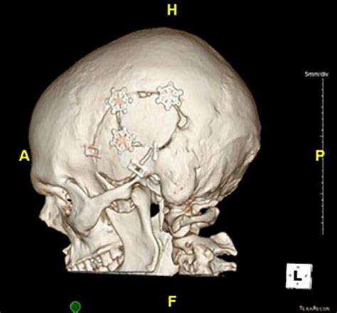 Preoperative Ct With 3d Reconstruction Showing The Previous Craniotomy