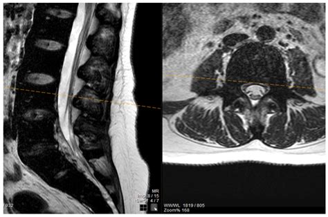 Spinal Cord Compression