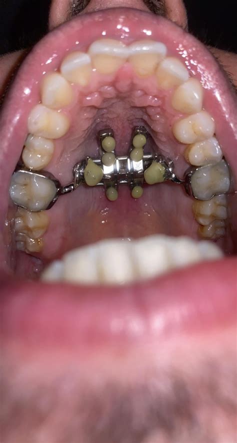 8 Screw Mse Just Split My Suture 24m My Story R Orthotropics