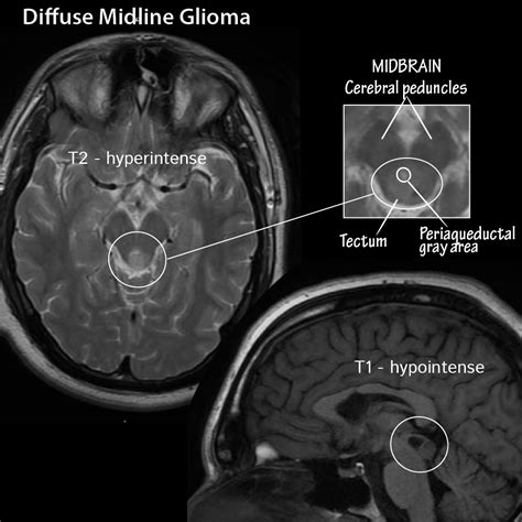 Clinical Pathology Glossary Diffuse Midline Glioma Ditki Medical And Biological Sciences