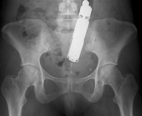 Top 10 X Ray Foreign Bodies • Litfl • Arcanum Veritas