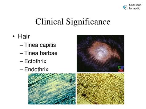 Tinea Capitis Ectothrix