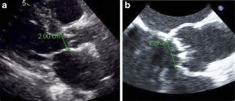 Aortic Annular Measurement By A Transthoracic Echocardiograpy