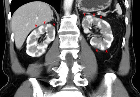 Igg4 Related Tubulointerstitial Nephritis Annals Of The Rheumatic