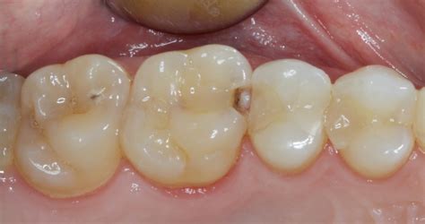 Closing The Class 2 Restoration Box Part 2 Management Of Direct Resin Spear Education Closing The Class 2 Restoration Box Part 2 Management Of Direct Resin Spear Education