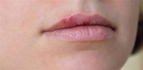 Signs And Symptoms Of Oral Herpes Read This Article Online Bridge Health