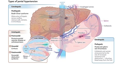 Portal Hypertension The New England Journal Of Medicine Facebook
