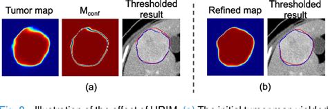 Figure From Multi Modal Tumor Segmentation With Deformable Aggregation And Uncertain Region