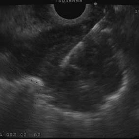 ERCP With Biliary Plastic Stent Placement In Patient With Common Bile Download Scientific